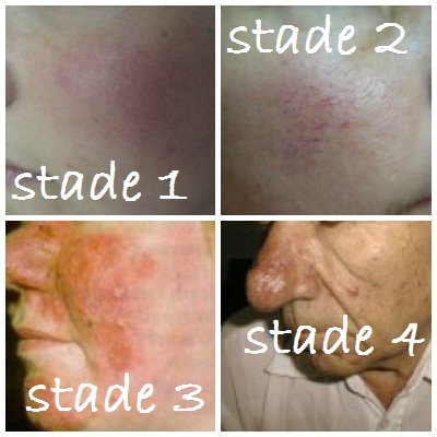 Diagnostiquer, comprendre et traiter la rosacée grâce à Roséliane | En ...